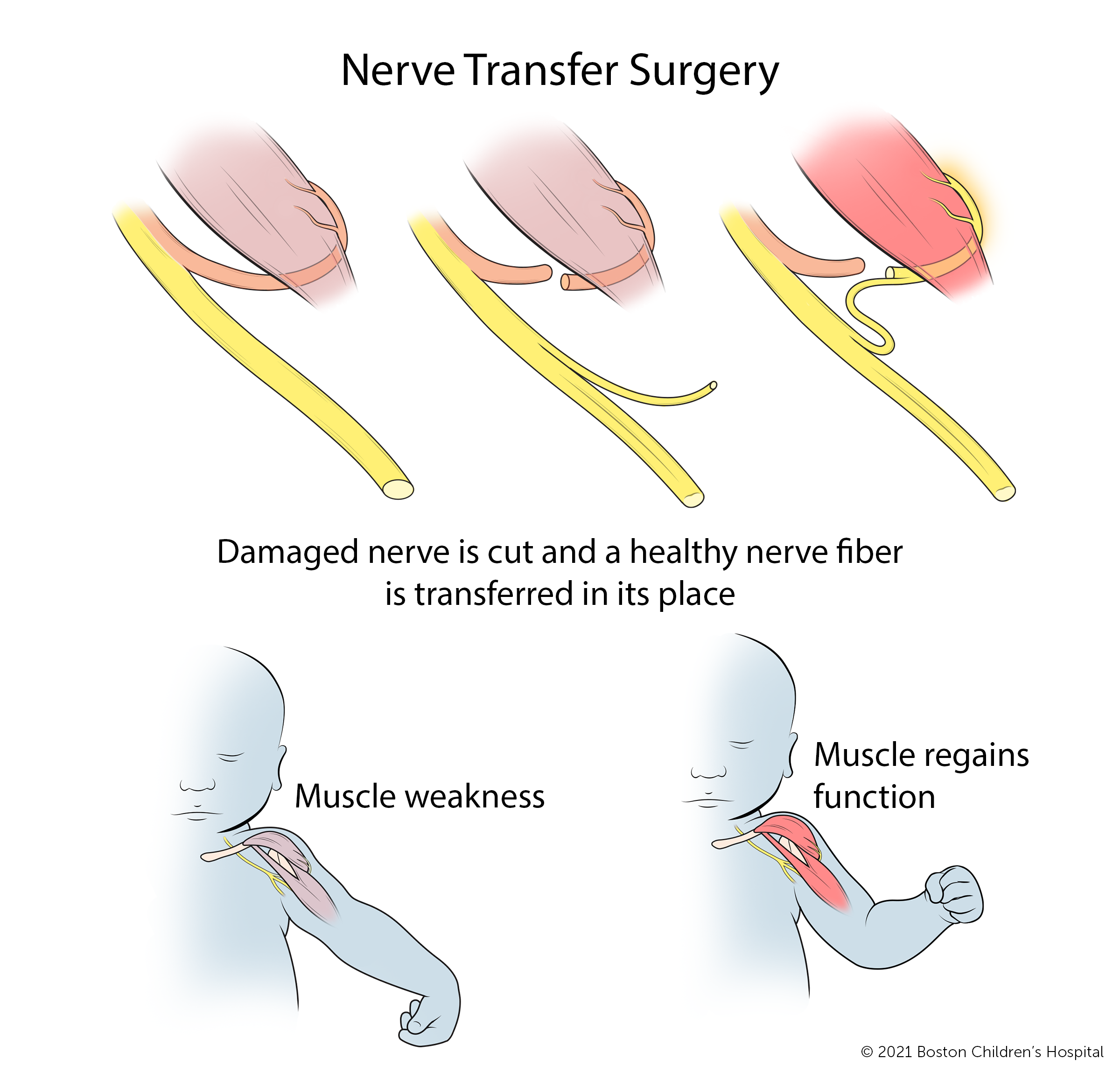 Brachial Plexus Birth Injury | Boston Children's Hospital Brachial Plexus Birth Injury | Boston Children's Hospital