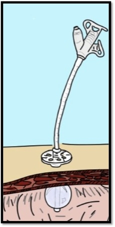 Feeding Tube Service | Home Care Instructions for Changing the MIC-KEY™ Skin Level Gastrostomy ...