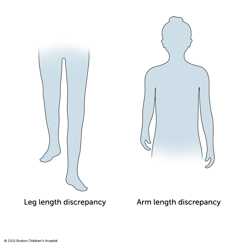 Limb Length Discrepancy Boston Children s Hospital