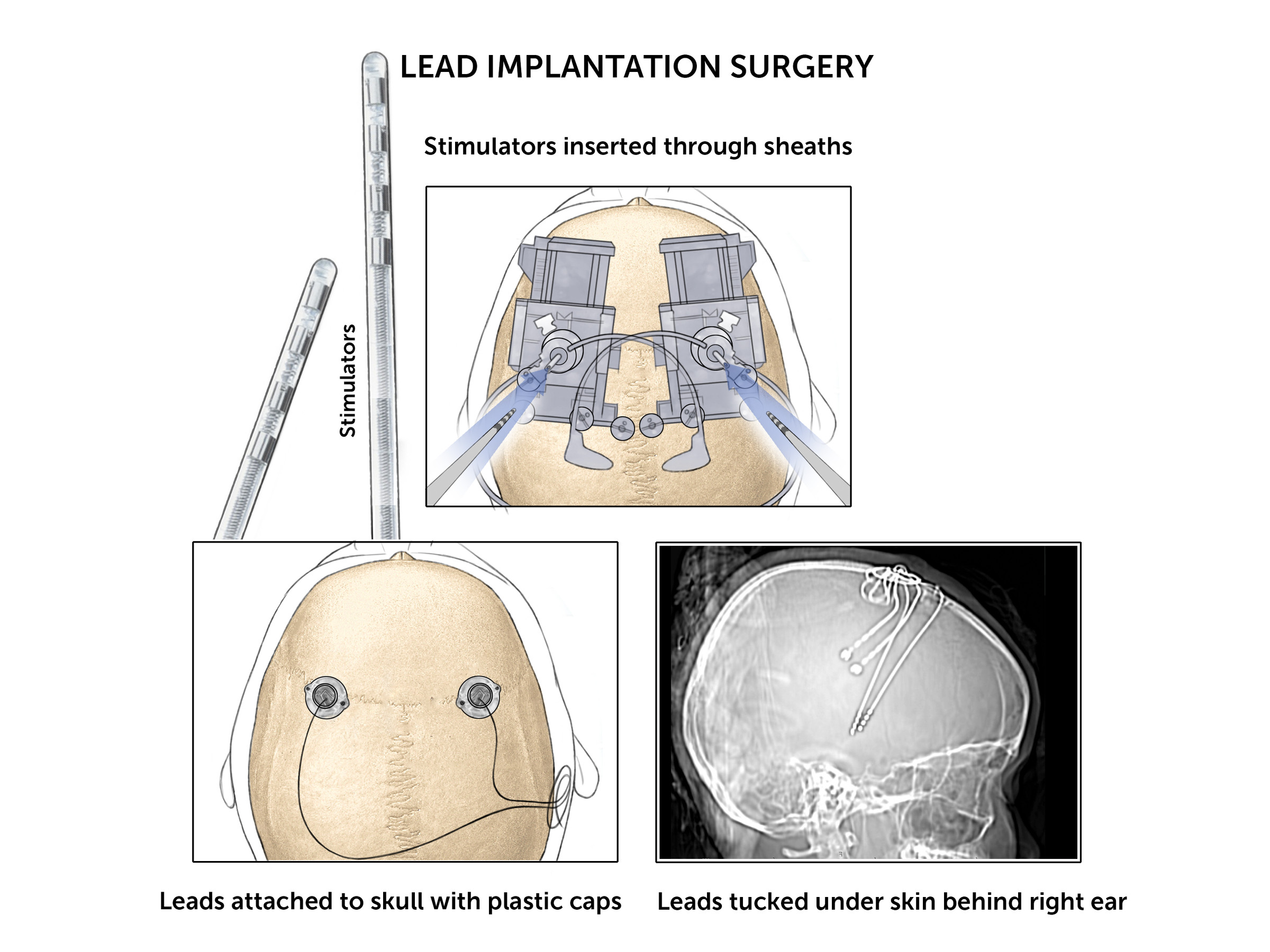 Deep Brain Stimulation Boston Children s Hospital Deep Brain Stimulation Boston Children s Hospital