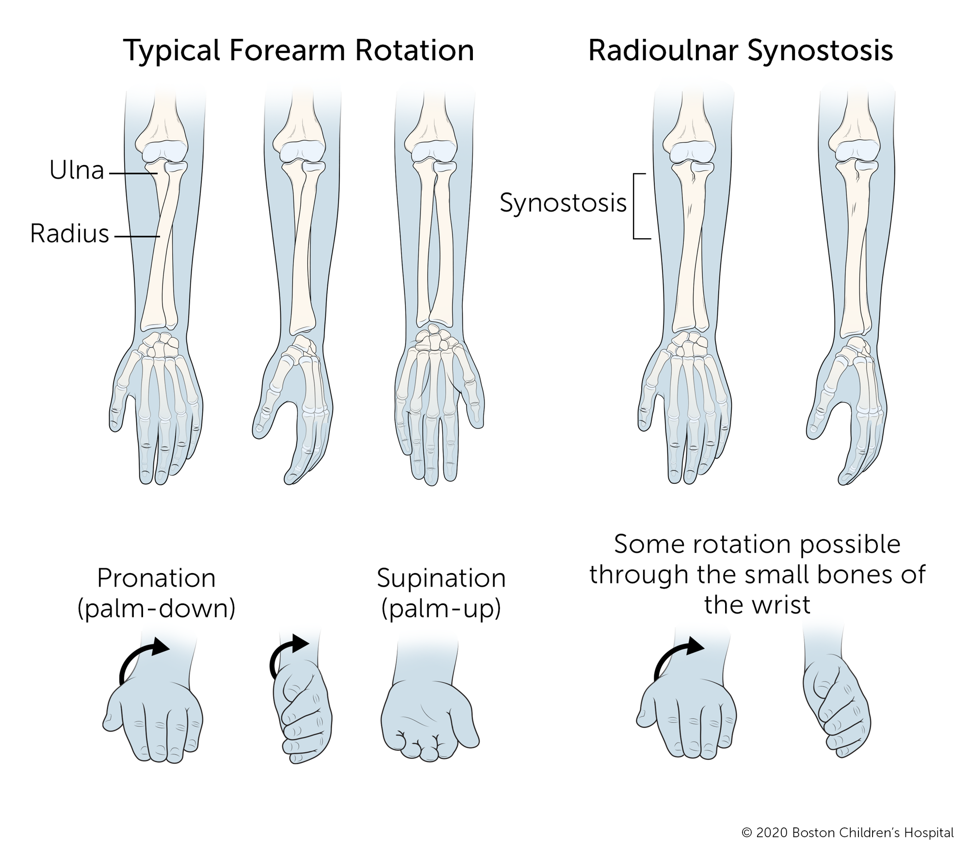 Radioulnar Synostosis Boston Children s Hospital Radioulnar Synostosis Boston Children s Hospital