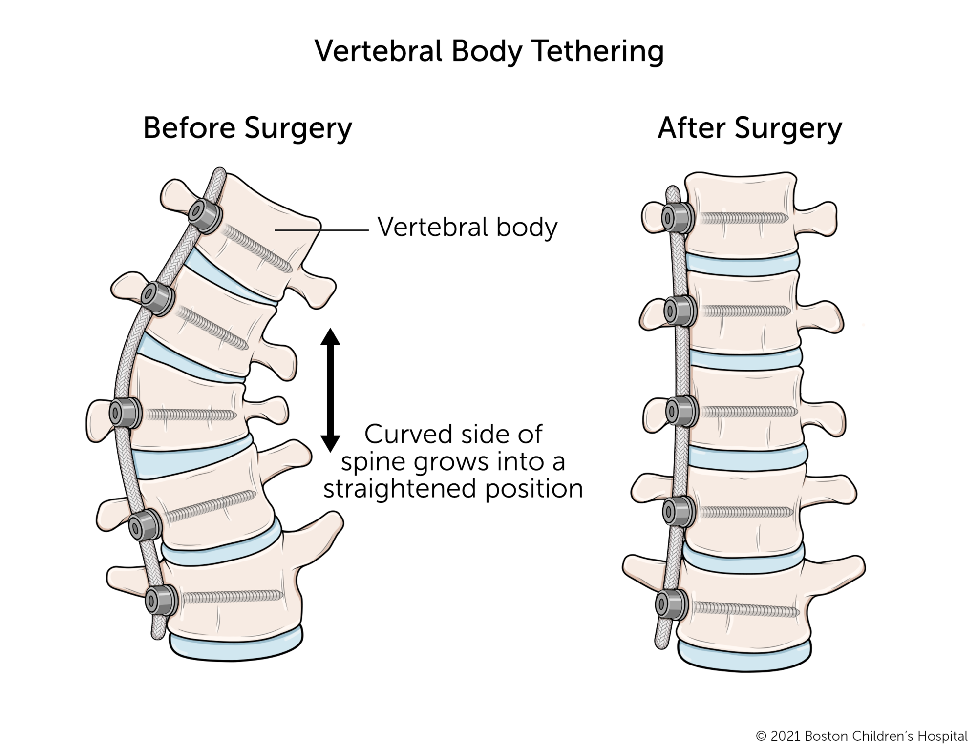 Vertebral Body Tethering Boston Children s Hospital