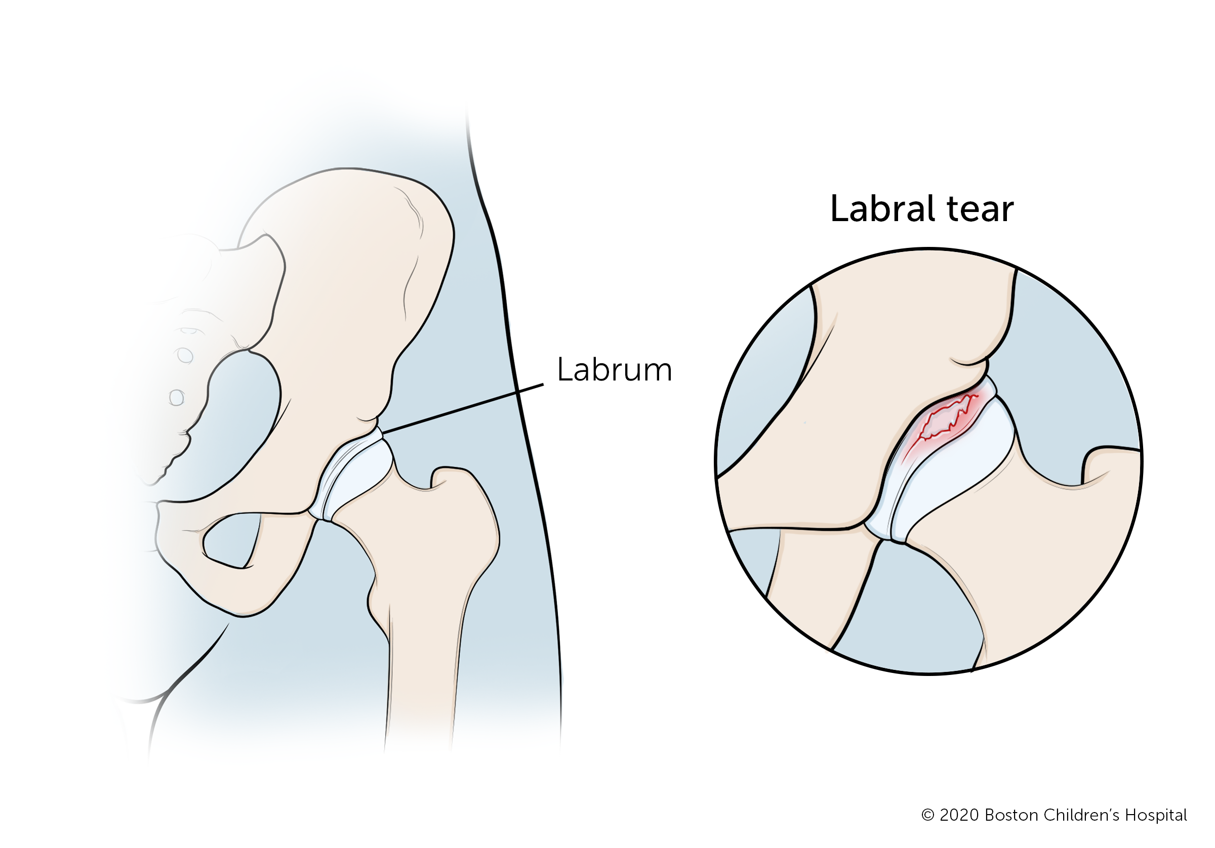 Hip Labral Tear Boston Children s Hospital