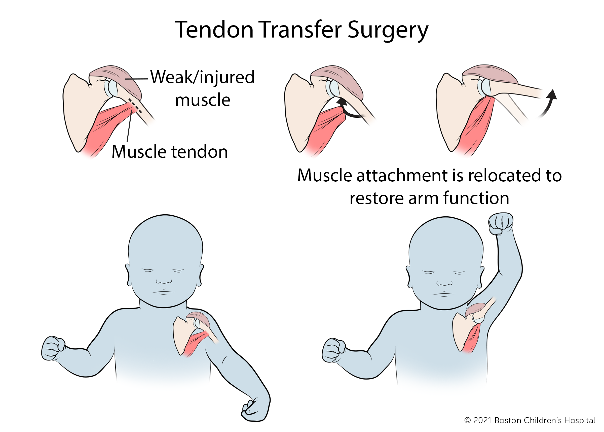 Brachial Plexus Birth Injury | Boston Children's Hospital Brachial Plexus Birth Injury | Boston Children's Hospital