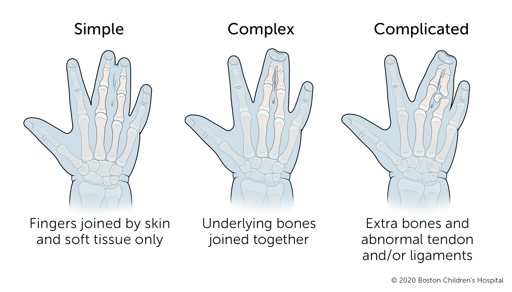 Syndactyly Boston Children s Hospital Syndactyly Boston Children s Hospital